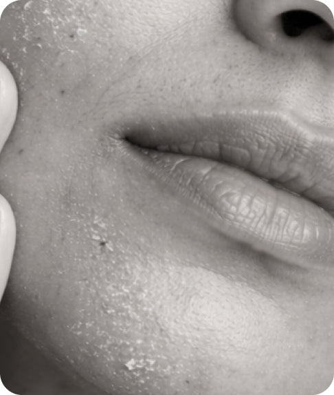 Acne-Prone & Breakout-Friendly Skin – Oladerm Skincare Llp